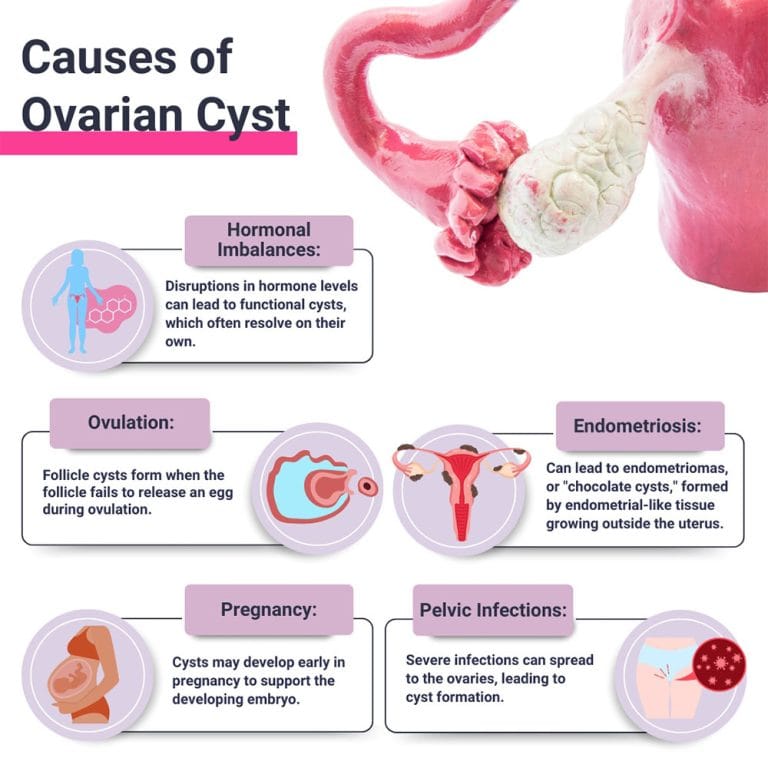 Ovarian Cyst Removal Midtown, NYC | Ovarian Cyst Specialists New York City