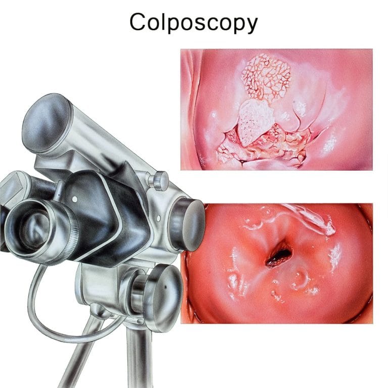 Colposcopy Procedure Midtown, NYC & Rego Park, Queens | Colposcopy Exam New York City