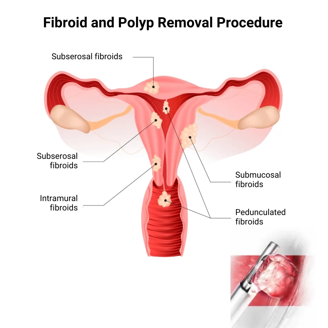 Procedure To Remove Cervical Polyps The Management Of Polyps In Female