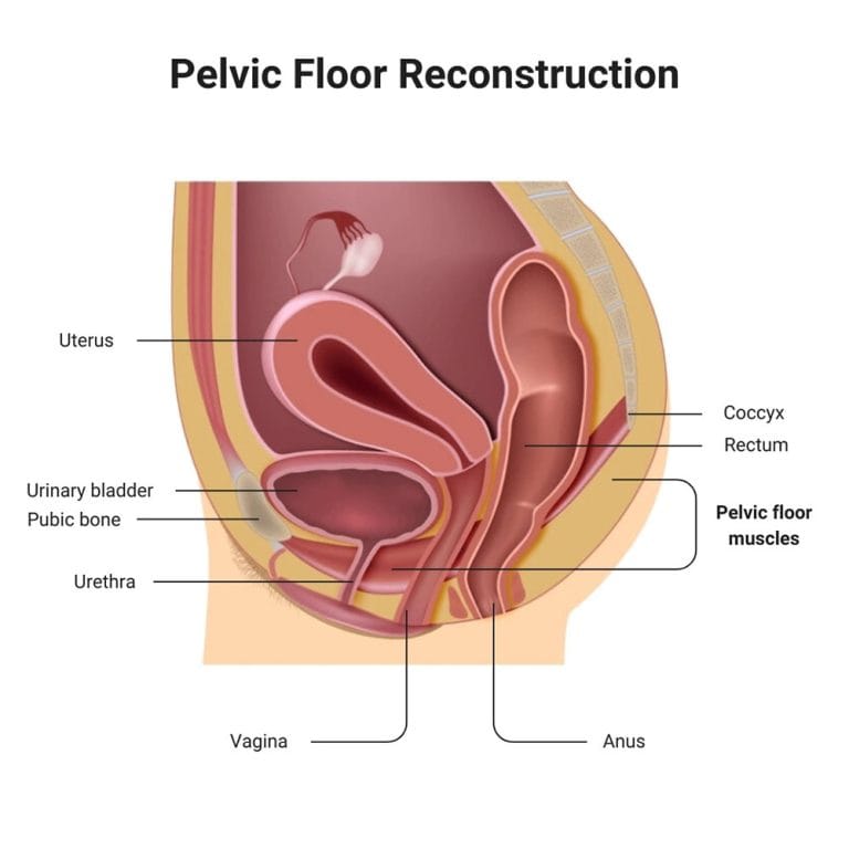Pelvic Floor Reconstruction Midtown, NYC & Rego Park, Queens