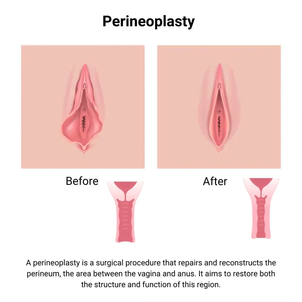 Perineoplasty Midtown, NYC & Rego Park, Queens | Scar Removal Perineoplasty Surgery New York City