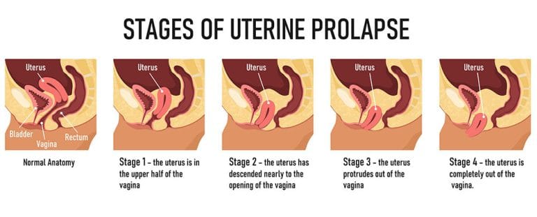 Pelvic Prolapse Treatment in Midtown, NYC & Rego Park, Queens | Prolapsed Uterus Diagnosed in ...