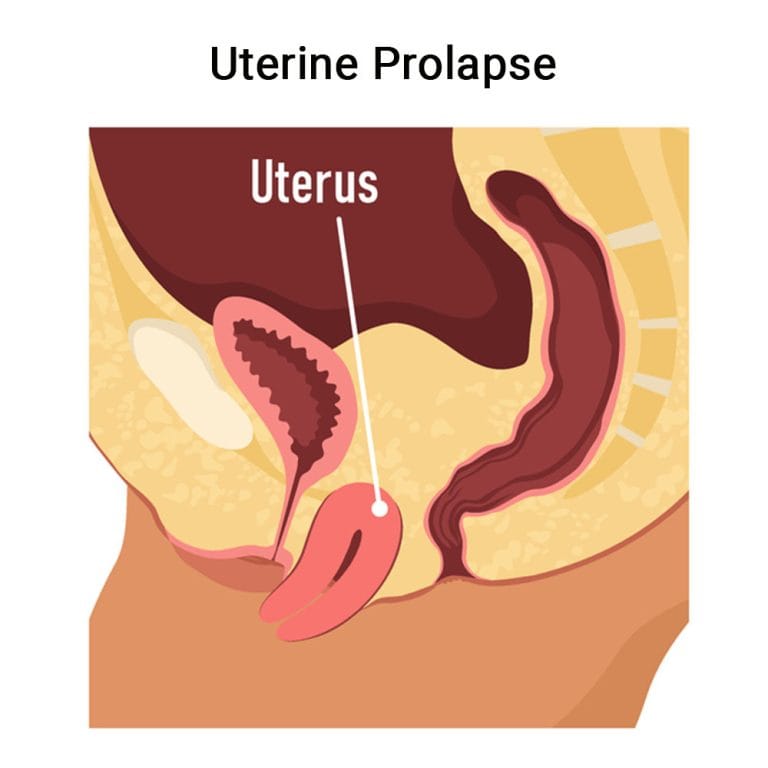 Pelvic Prolapse Treatment in Midtown, NYC & Rego Park, Queens | Prolapsed Uterus Diagnosed in ...