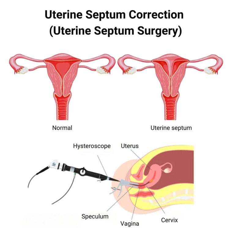 Uterine Septum Correction Midtown, NYC & Rego Park, Queens | Uterine Septum Surgery New York City